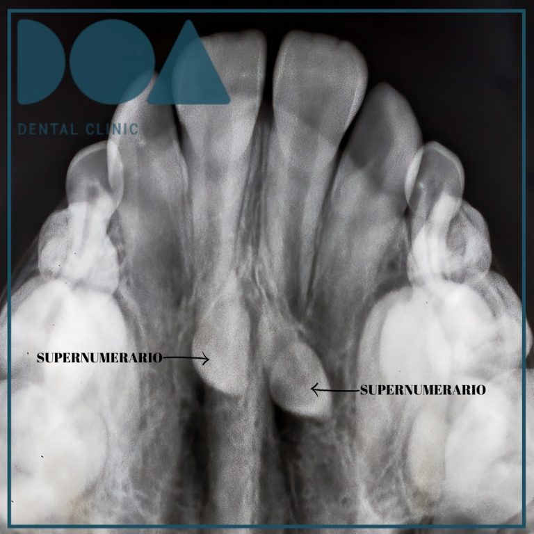 ¿QUÉ ES LA HIPERDONCIA? - DOA. Dental Clinic